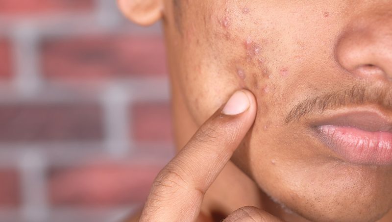 Acne Scars vs Hyperpigmentation: What Works for Each